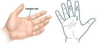 Spijkenisse Medisch Centrum - patiëntfolder: Ganglion in de vinger
